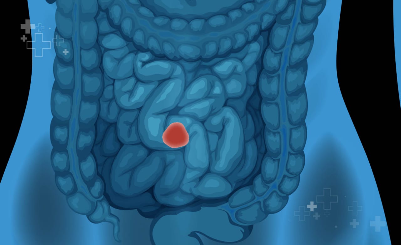 Você sabia que existe tumor no intestino delgado? – Dr. Diego Greatti ...